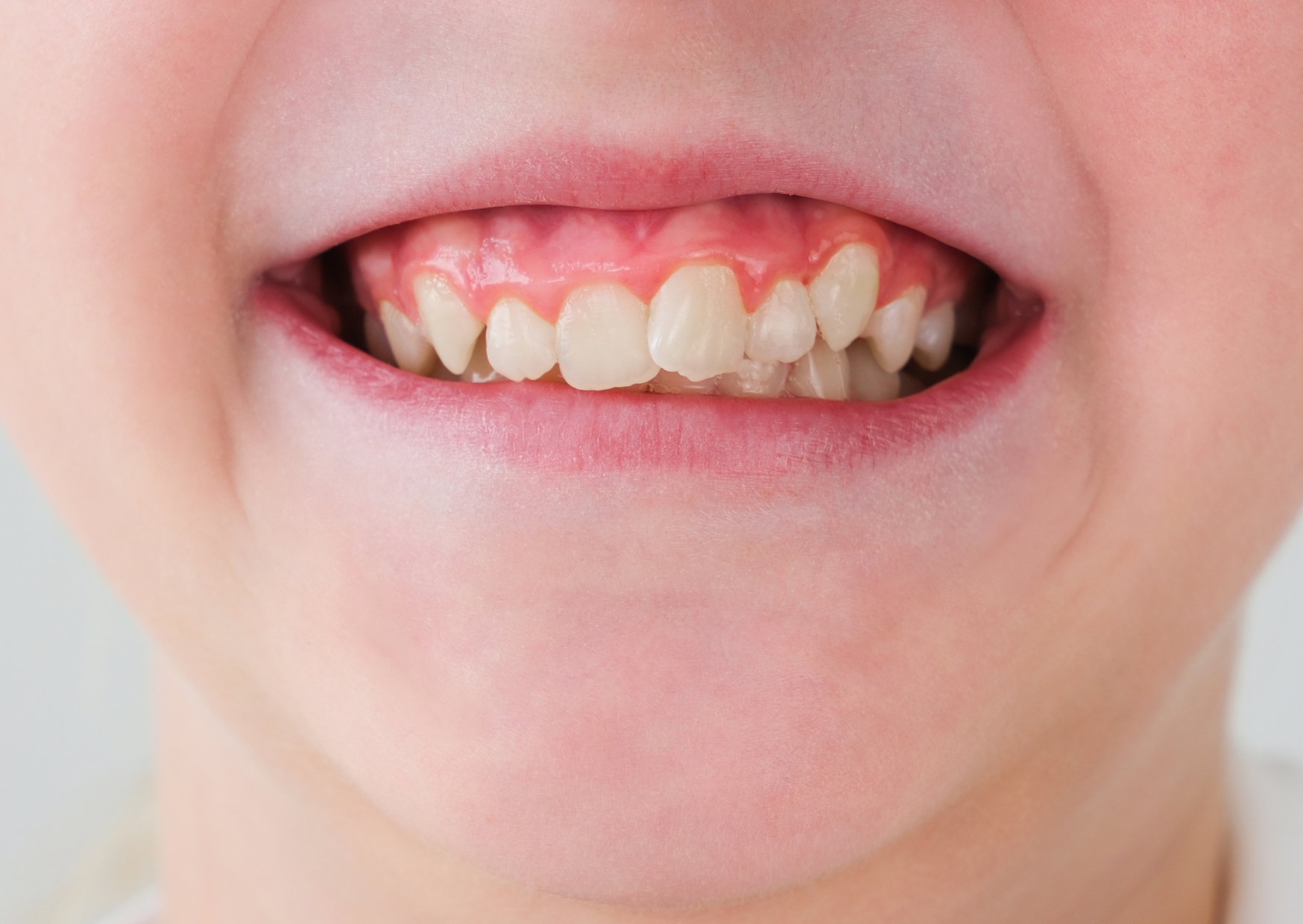 The British Teeth Americans Spend $50,000 To “Fix” That Work Fine